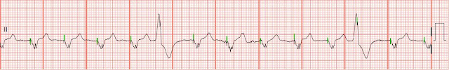 EKG Rhythm Strips 25: Ectopic beats