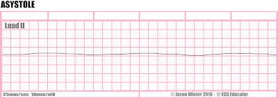 ECG Educator Blog : Asystole