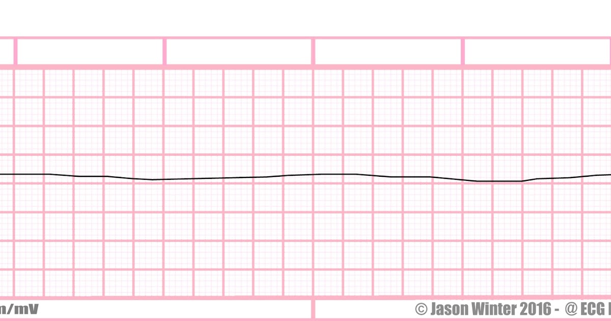 ECG Educator Blog : Asystole