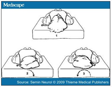 Study Notes: BPPV (Benign paroxysmal positional vertigo)