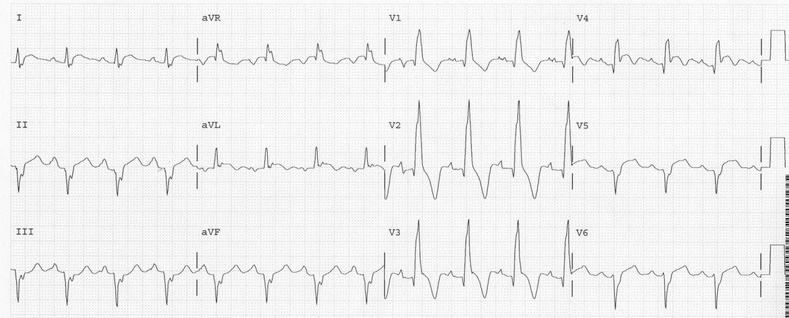 Dr. Smith's ECG Blog: Young Woman with history of repaired Tetralogy of ...