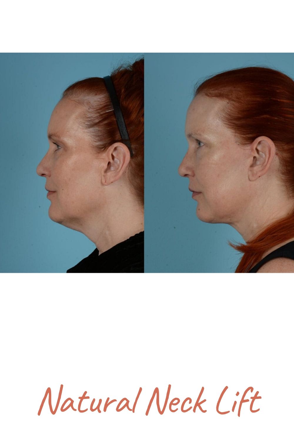 Natural Neck Lift - Pukrol Satwa