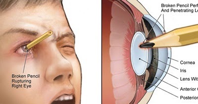 Causes Of Perforating Eye Injury : Sight Medical Blog