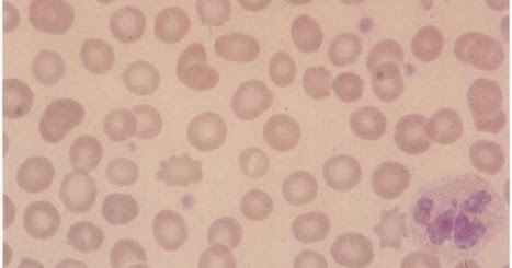 FICHERO HEMATOLOGIA : Equinocito