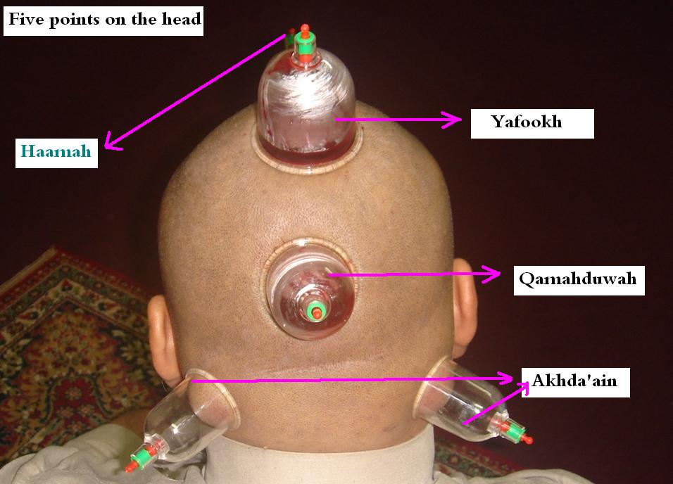 aamirbinehsan: Hijama Gallery