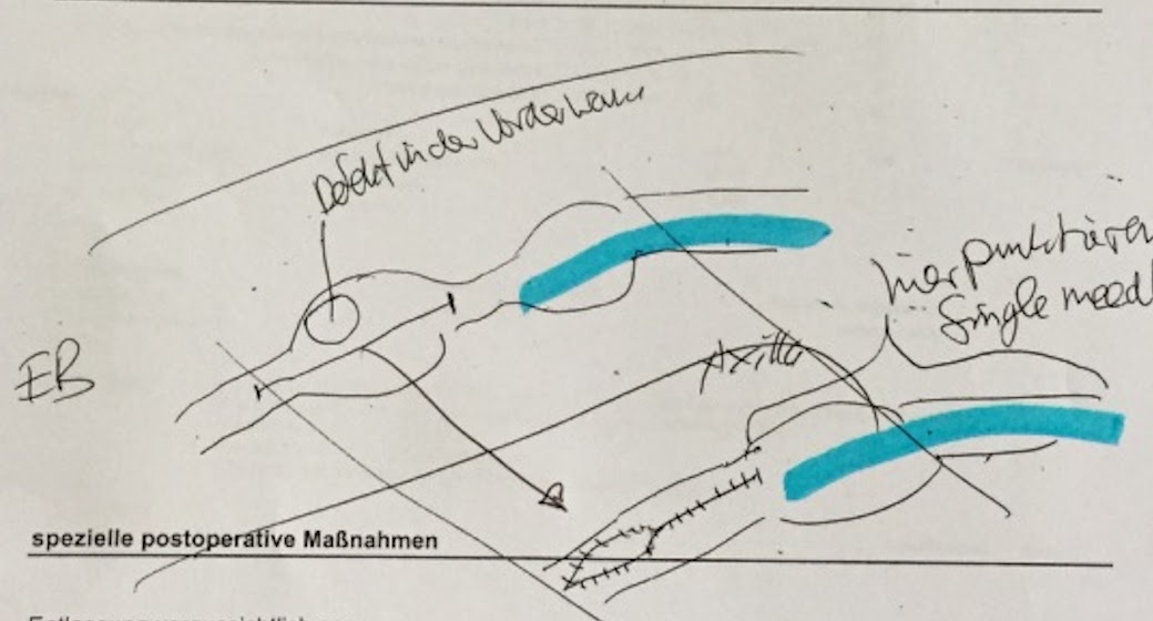 Things people say: Shunt Revision [Warning: blood-drenched photos of shunt]