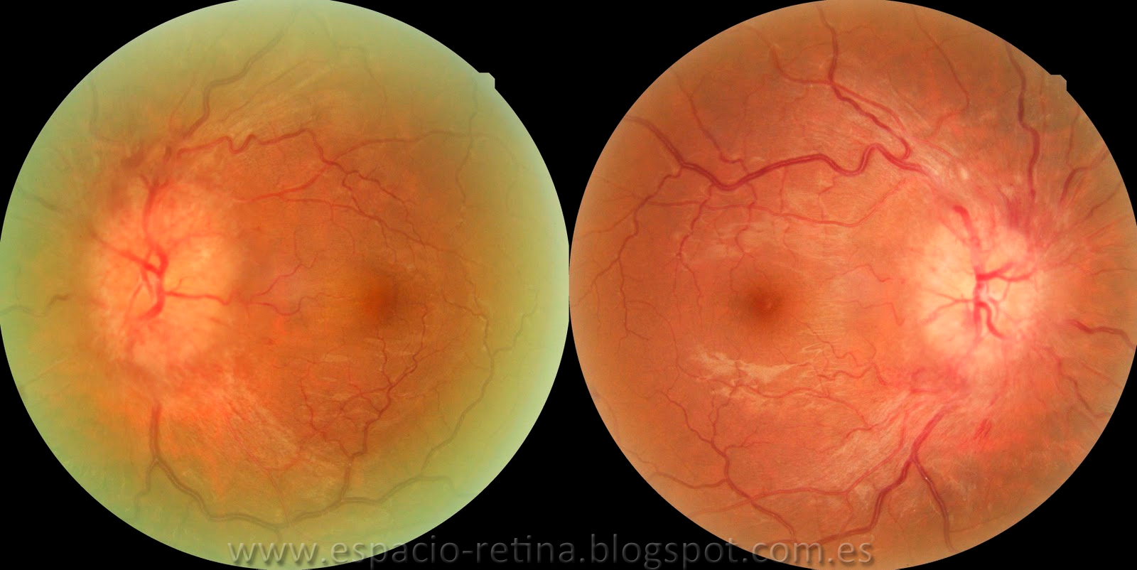 ESPACIO RETINA: Papiledema.