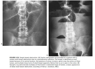 Sudiyatmo,MD Blog & Journal: Ileus Obstruksi (Obstruksi Intestinal)