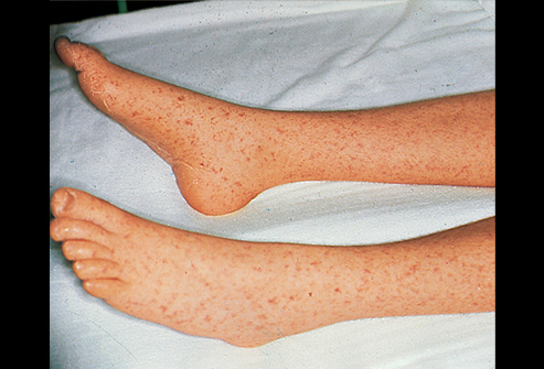 Medical and Health Information: Rocky Mountain spotted fever