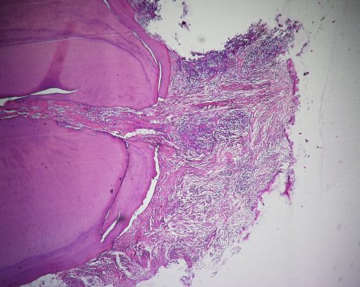 Dentistry and Medicine: Periapical periodontitis