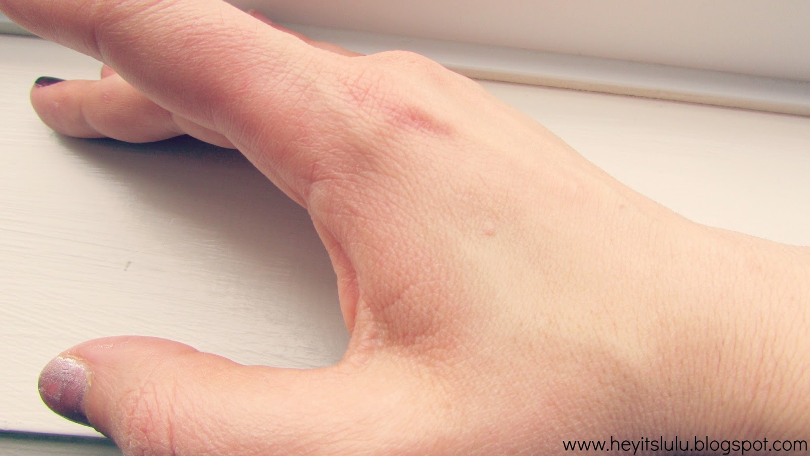 How I Treated My Burn (UPDATED)