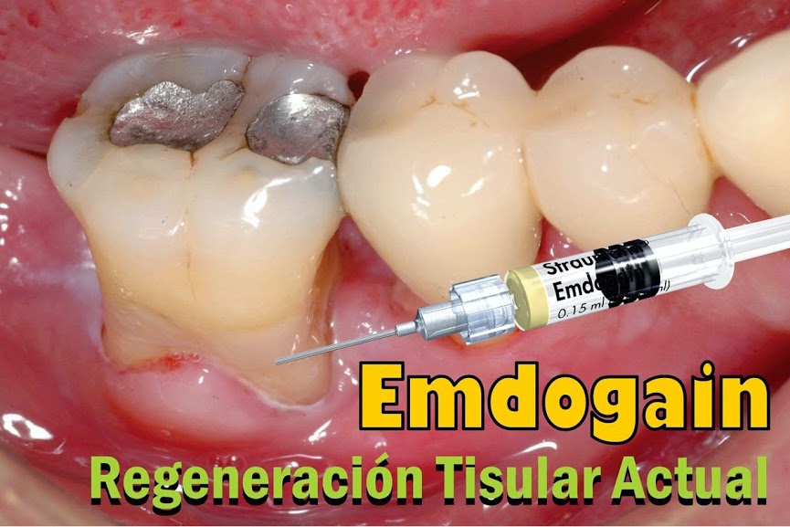 WEBINAR: EMDOGAIN y Regeneración Tisular Actual - Dra. Magaly Cruz ...