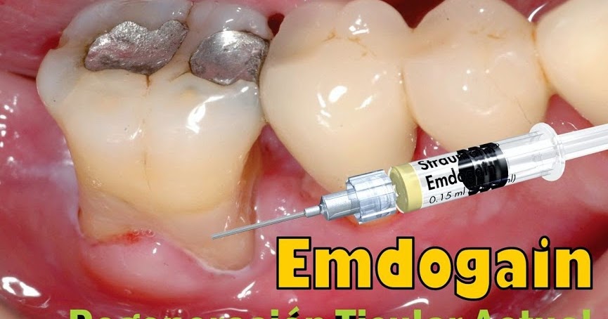 EMDOGAIN y Regeneración Tisular Actual - Videoconferencia de la Dra ...