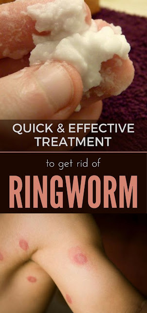 Home Remedies For Ringworm - TOP 5 DIY