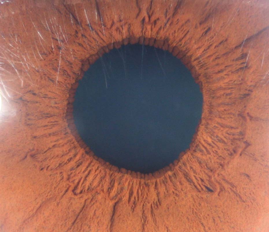 Modern & Multidimensional Iridology: IPB Hypertrophy/ Morphology, Pupil ...