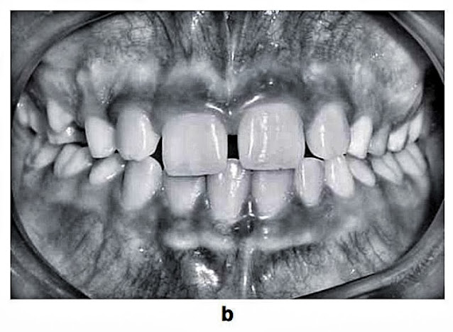 PDF: Associated Dental Anomalies: case report