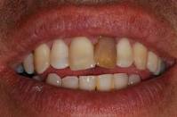 Graying teeth? : r/Dentistry