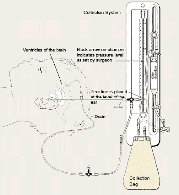 Living the Chronically Wonderful Life: POTS, EDS, gastroparesis, and ...
