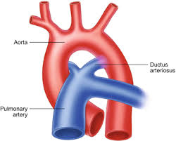 Patent Ductus Arteriosus (PDA) - How To Guide | Tips And Tricks ...