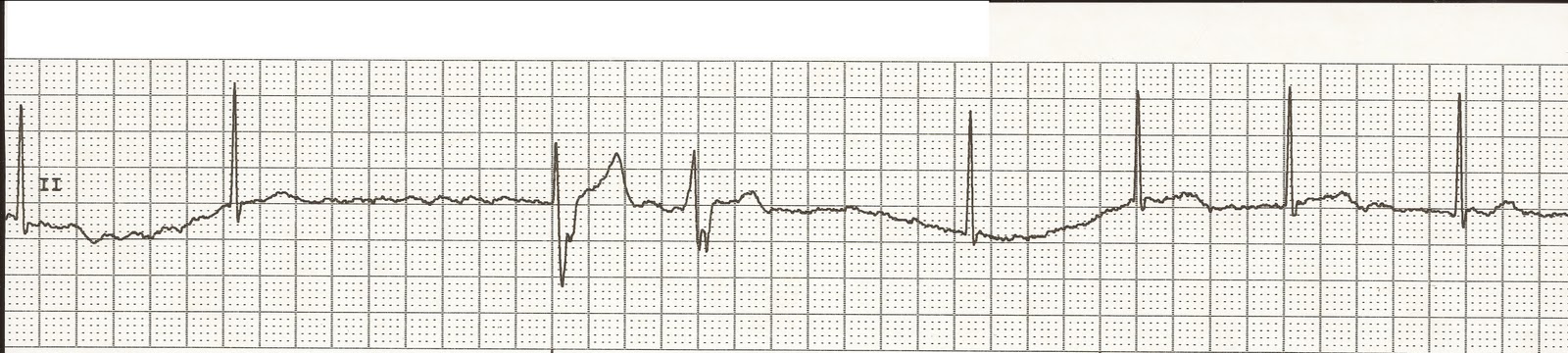 EKG Rhythm Strips 26: Ectopic beats