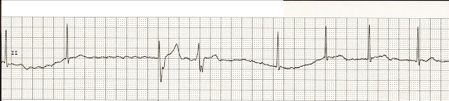 EKG Rhythm Strips 26: Ectopic beats