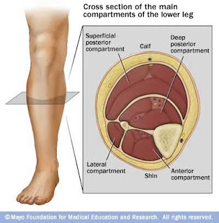 My Experience with Chronic Exertional Compartment Syndrome