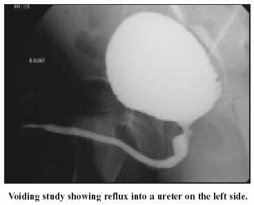 syuhada .. permata hati ibu..: MCUG - 'micturation cystourethrogram'