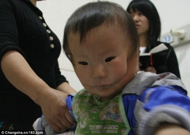 Meet China's 'mask boy': Child appears to have two faces due to rare ...