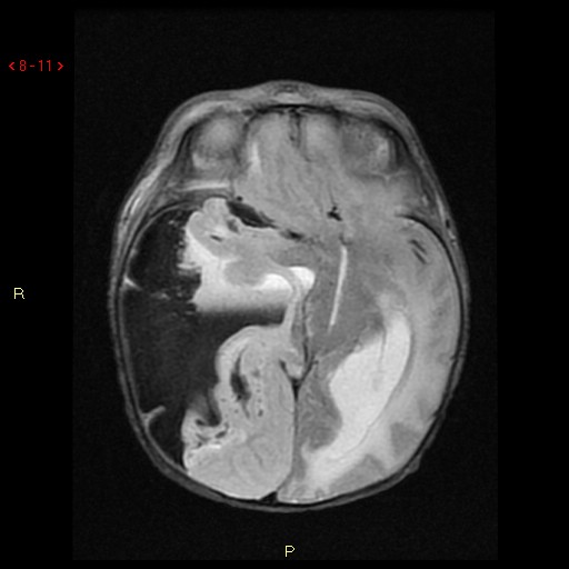 pediatric neurology: Neonatal extra-axial hemorrhage