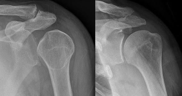 What Is Dislocation? - Teroes