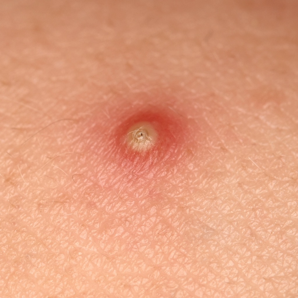 FAN MAIL FRIDAYS The Difference Between Cystic Pimples And White Eyed fan-mail-fridays-the-difference-between-cystic-pimples-and-white-eyed