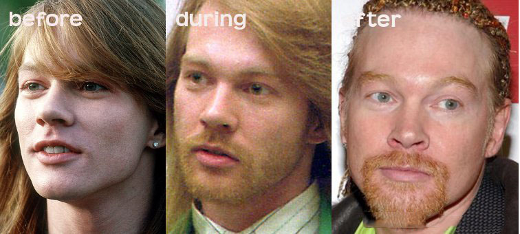 MUSIC & MOVIE: Axl Rose Plastic Surgery