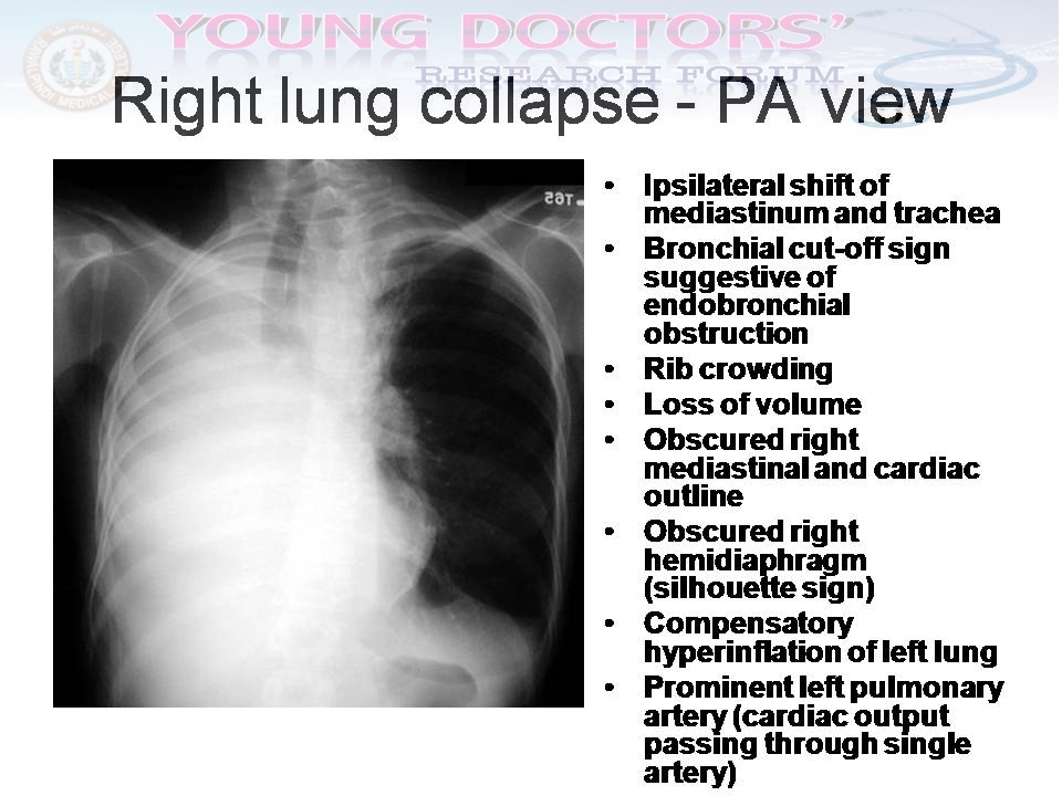 Quick Diagnosis Of The Chest X-Rays (CXR) ~ YOUNG DOCTORS' RESEARCH FORUM