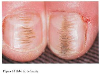 Nail Diseases: Habit Tic Deformity