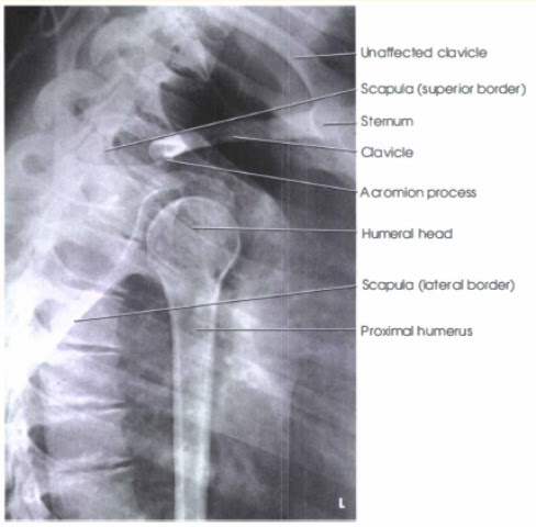 TRANSTHORACIC LATERAL PROJECTION: HUMERUS (TRAUMA) - RadTechOnDuty