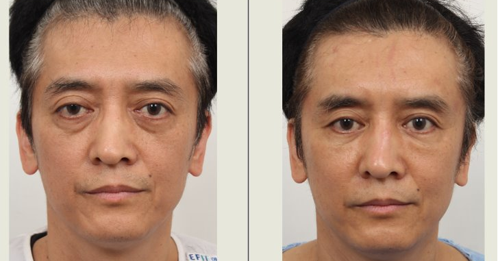 EFIL Bulging Eyes Plastic Surgery JCI: Orbital Expansion Surgery ...