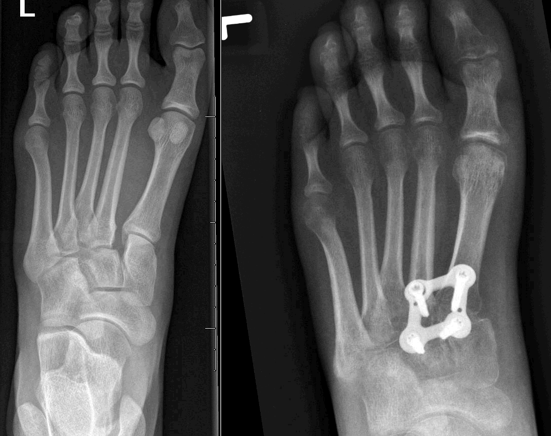 www.lisfranc.ca - Lisfranc Fracture / Injury Blog: Lisfranc / Midfoot ...