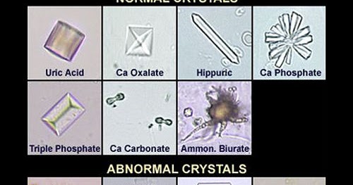 Medical Laboratory and Biomedical Science: Chrystals in Urine