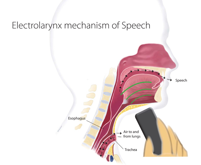 Electrolarynx How It Works