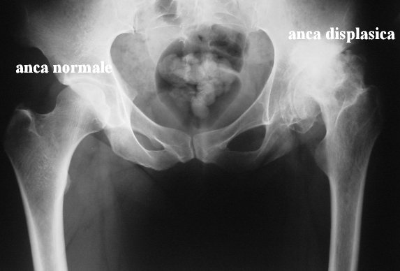 Dott. Leonardo Donati - Medico Specialista in Ortopedia: Artrosi dell ...