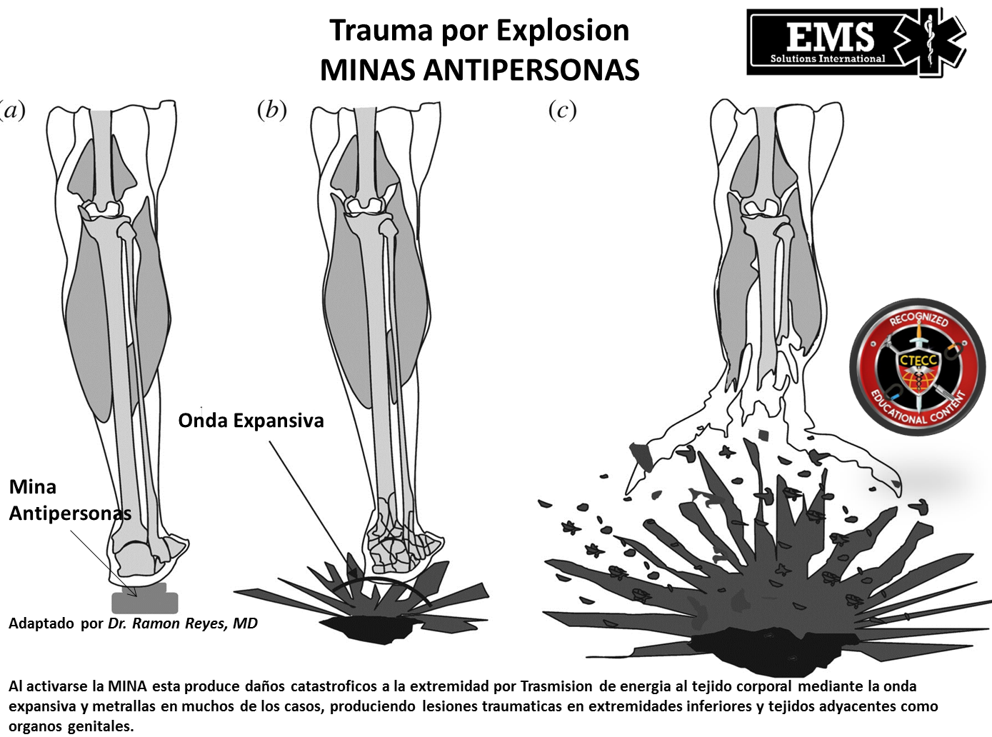 Cinematica de Trauma ATROPELLO, Explosion, Peatones | MED-TAC ...