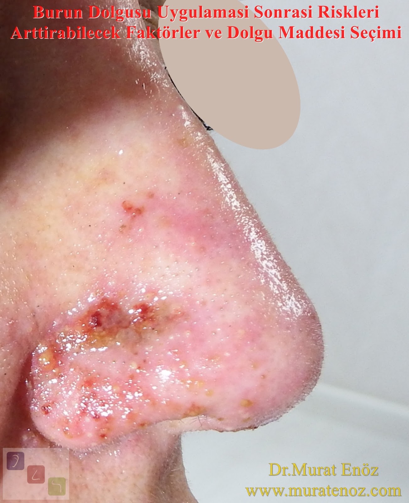 Selection of Filler Material and Factors to Increase Risks After Nose ...