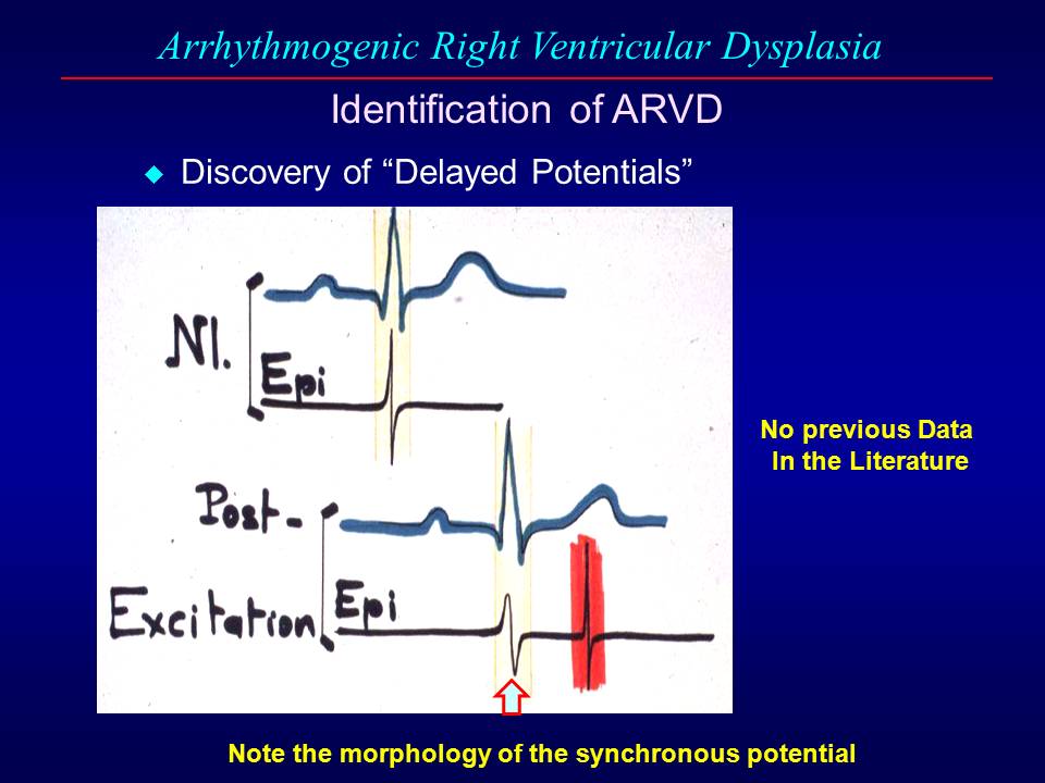 ARVCsGF: Advances in ARVD ECG interpretation