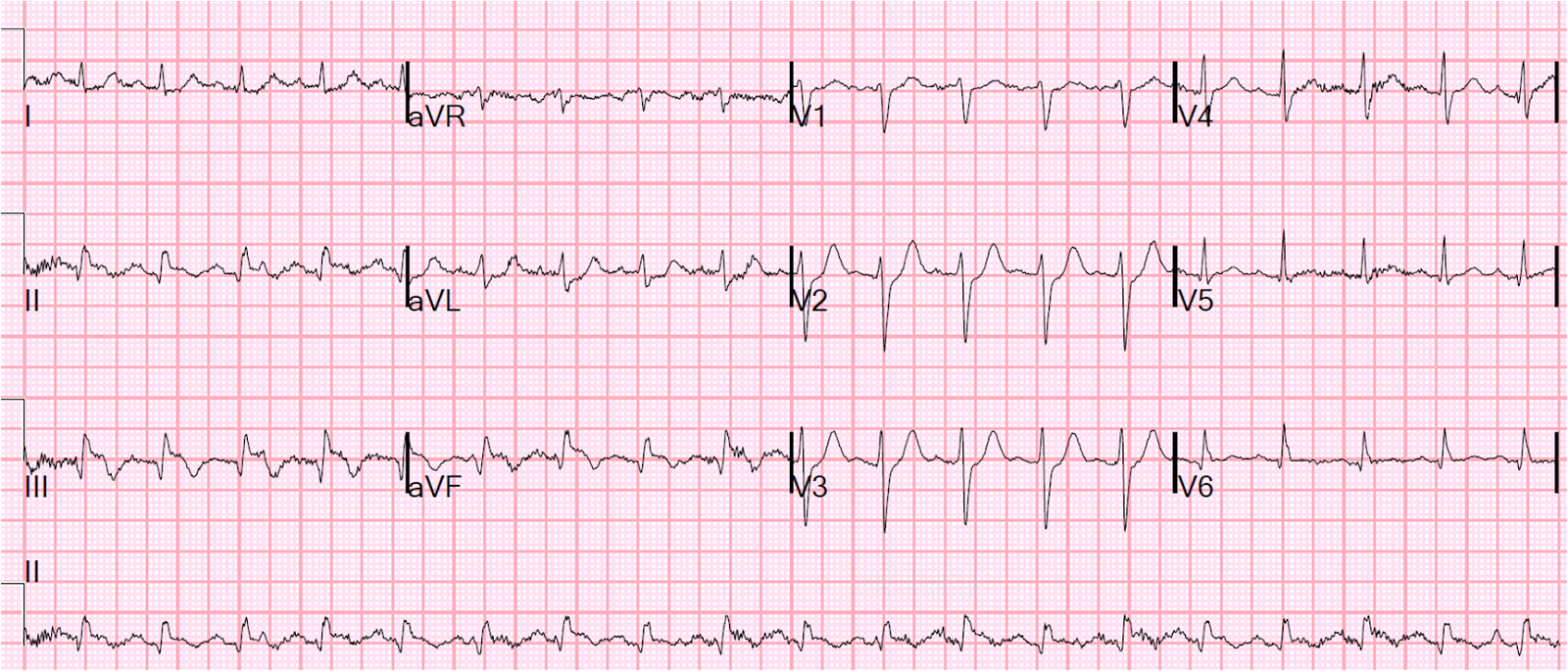 Dr. Smith's ECG Blog: Pulmonary Edema, Hypertension, and ST Elevation 2 ...