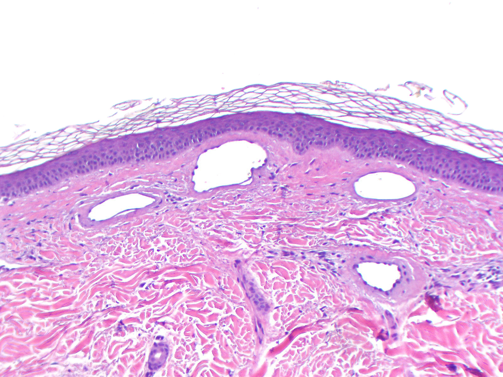 VIRTUAL GRAND ROUNDS IN DERMATOLOGY 2.0: Unusual Vascular Pattern