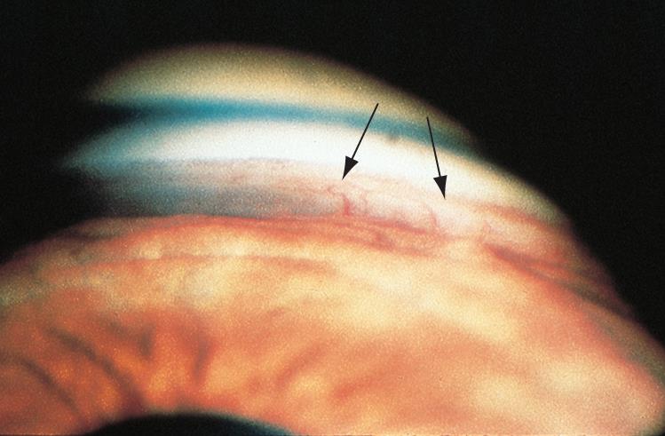 Glaucoma Specialist Blog: The "Glog"