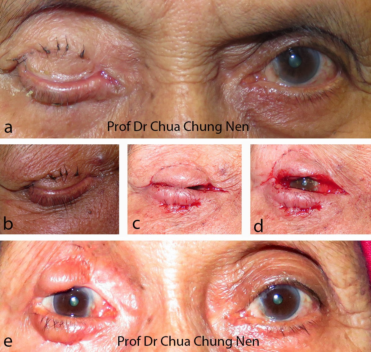 Eyelid Surgery by Prof Dr CN CHUA 蔡鐘能: 2015