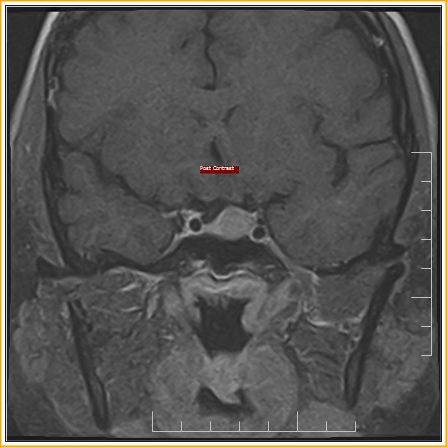 Rathke's Cleft Cyst :MRI - Sumer's Radiology Blog