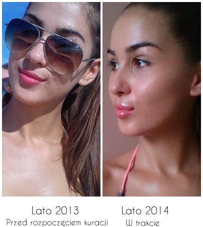 Axotret - moja kuracja | PolskieSzafiarki.pl i najlepsze blogi, blogi ...