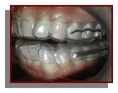 Sonoclean - tratamento para apneia do sono: Aparelho intra oral para ...